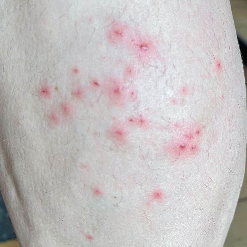 Erster Patient mit Affenpocken-Virus in Deutschland genesen ...