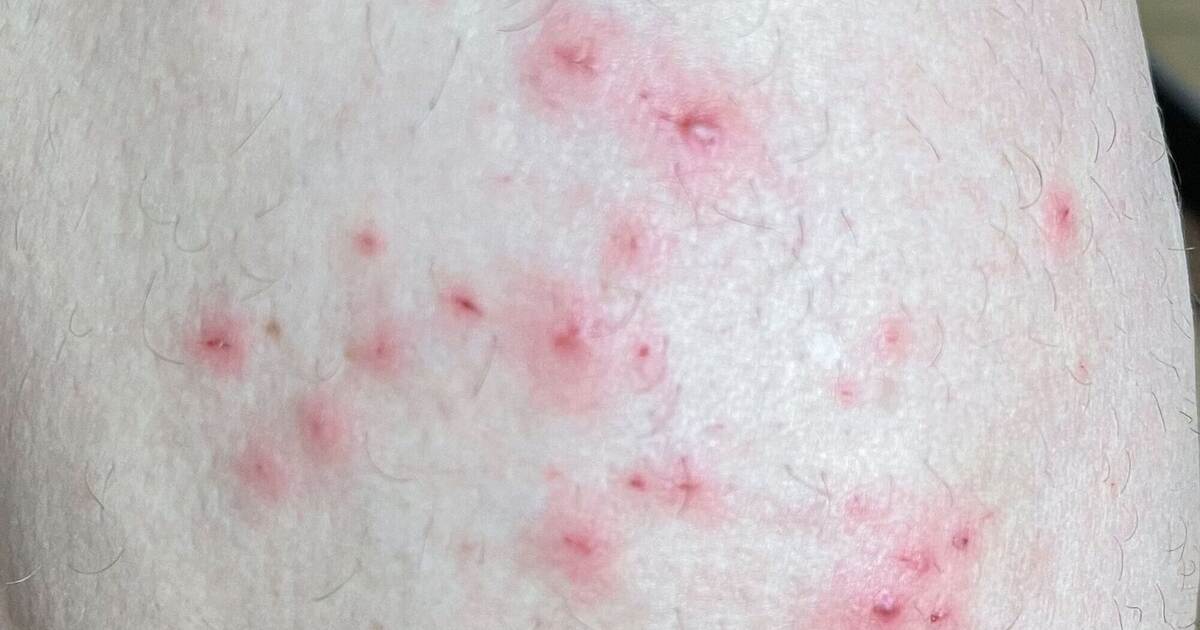 Erster Patient mit Affenpocken-Virus in Deutschland genesen ...